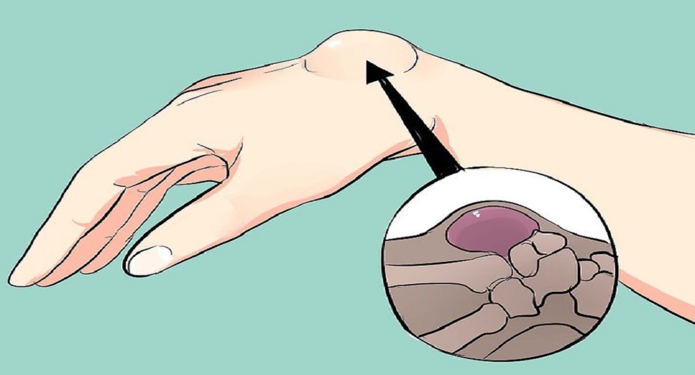 Cisti sebacea: cos'è, cause e trattamento